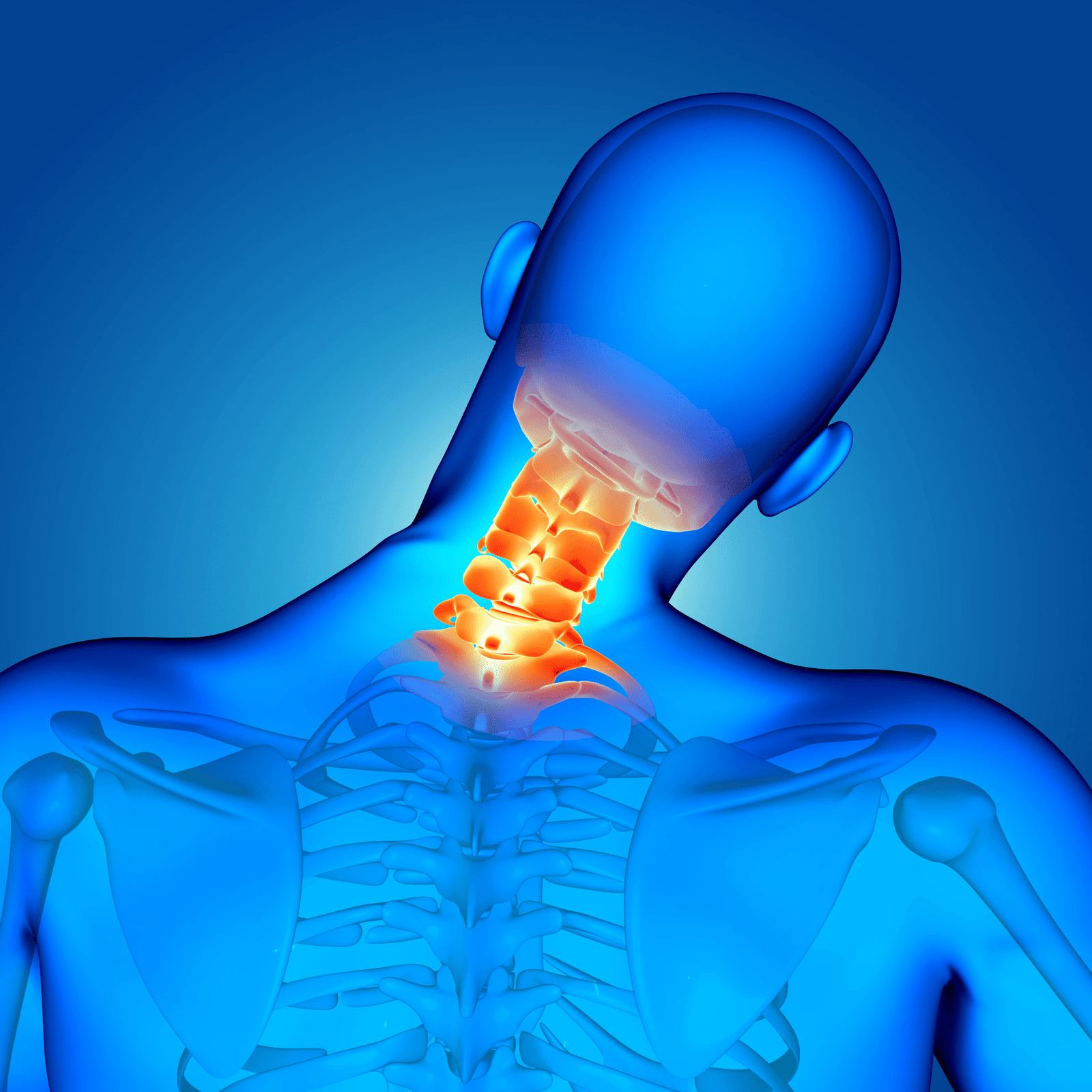 Cervical Spondylosis Treatment - The Spine Doctor